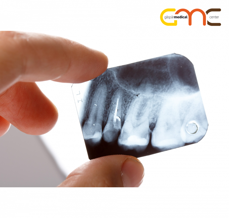 Mikor szükséges a fogak gyökérkezeléssel történő előkészítése ...